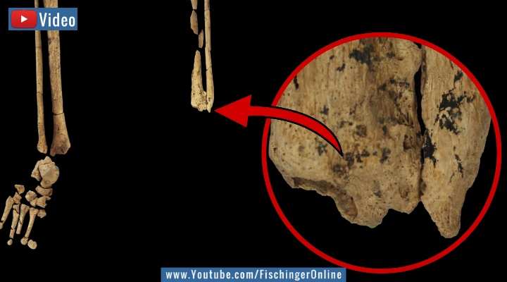 Vor 31.000 Jahren konnten Steinzeit-Mediziner in Asien amputieren